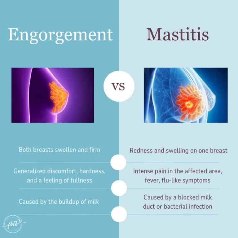 Engorgement vs mastitis: Understanding the difference